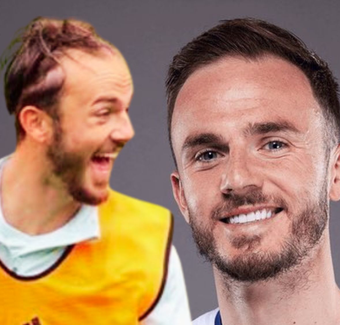 How Much Did James Maddison Spend on His Hair Transplant? – Thick Accent