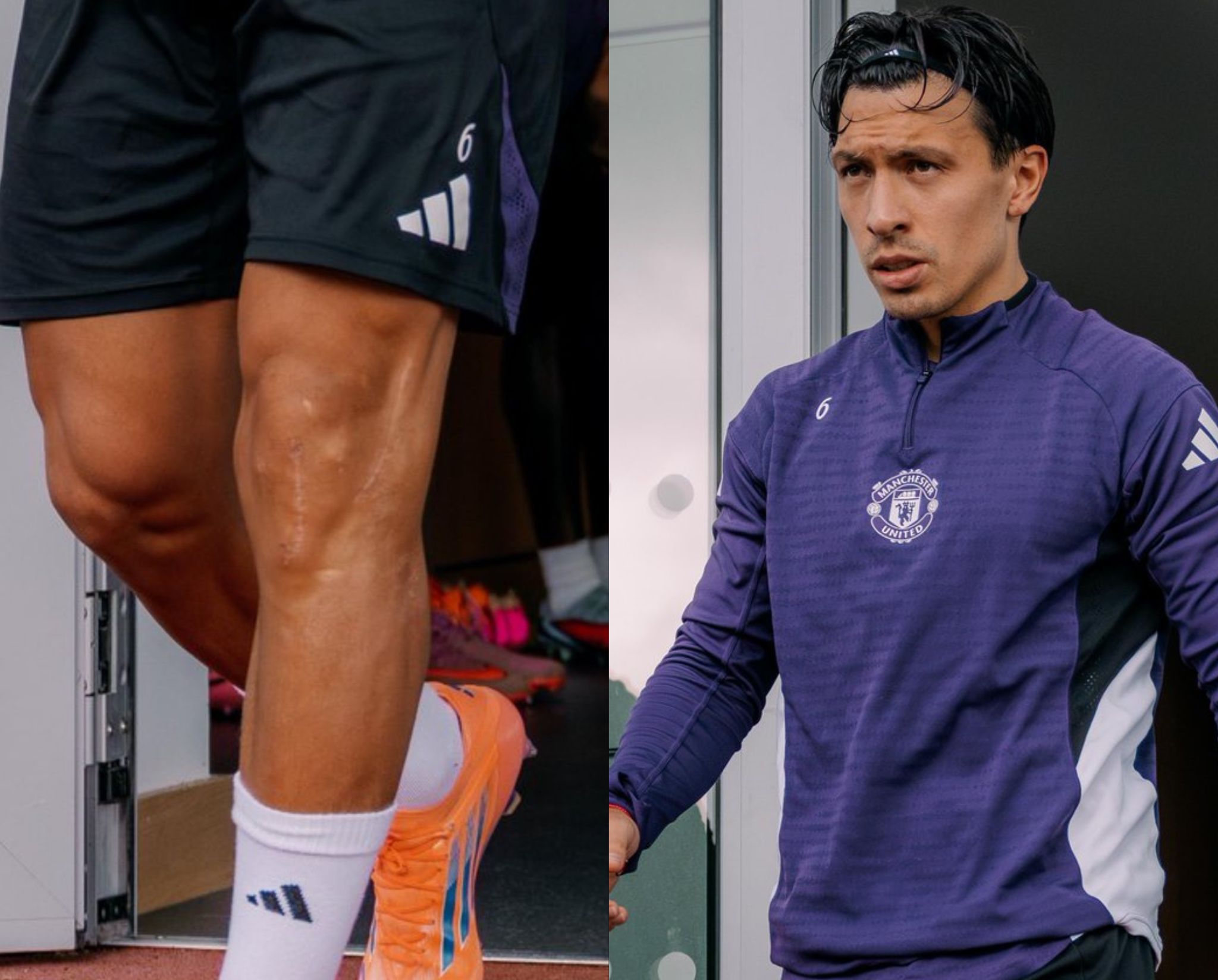 This Gnarly Scar on Lisandro Martinez’s Leg Shows the Price of Playing ...